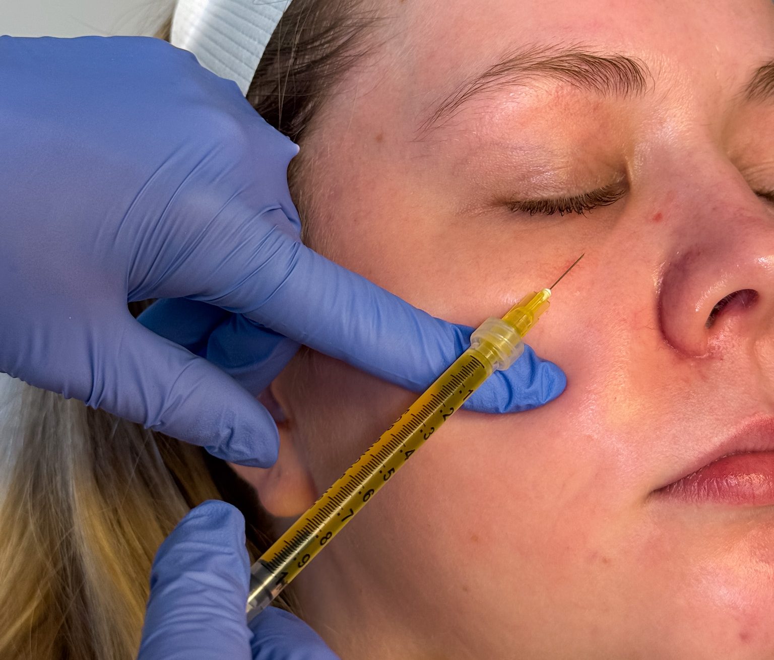 PRP Under Eye Injection – Orchid Aesthetics